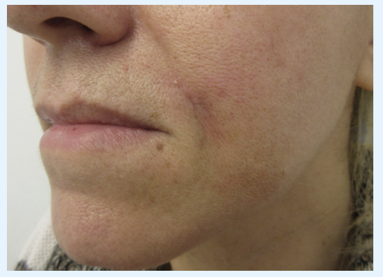 Management Of Nodules Post Filler Injection
